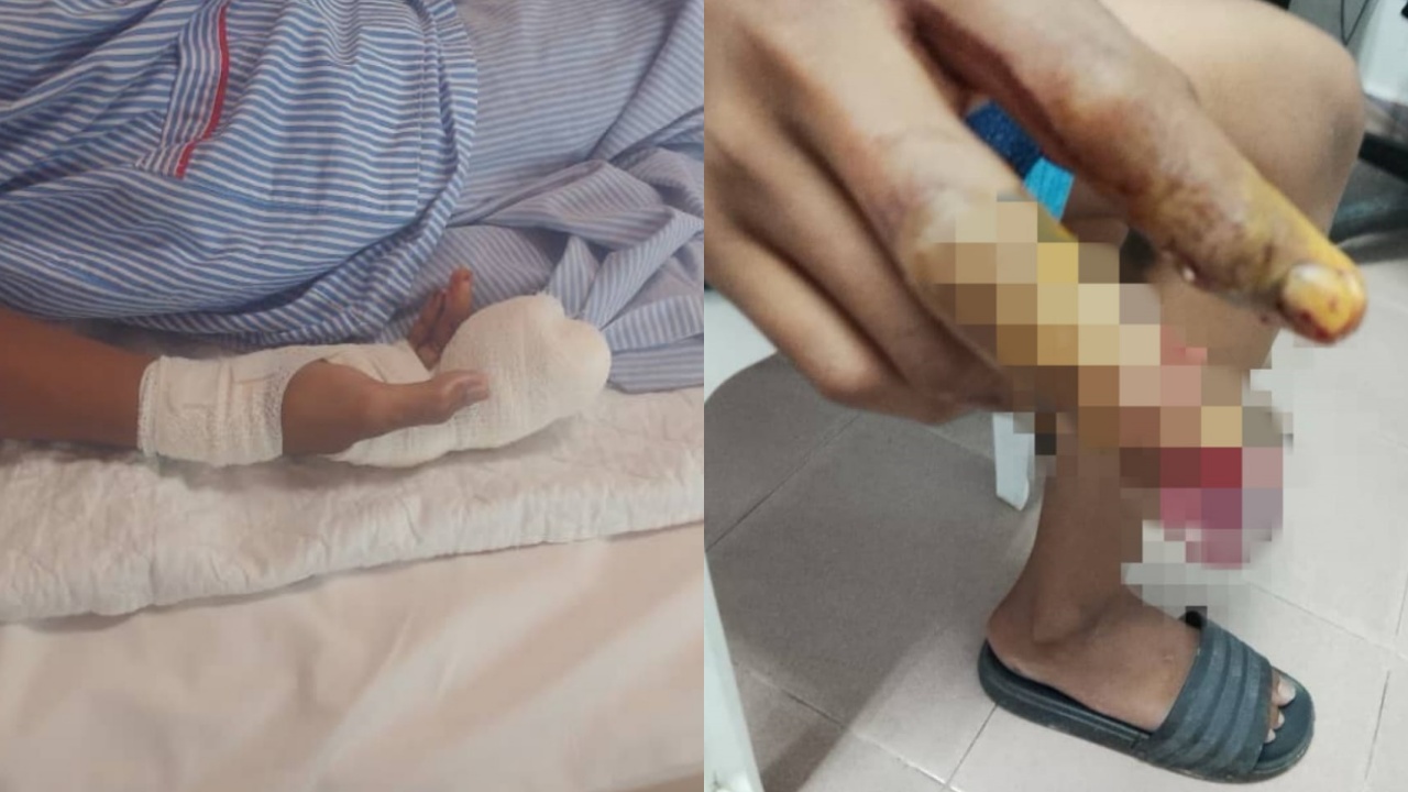 14yo Suffers Two Broken Fingers and Loses Part of One After Firecracker ...