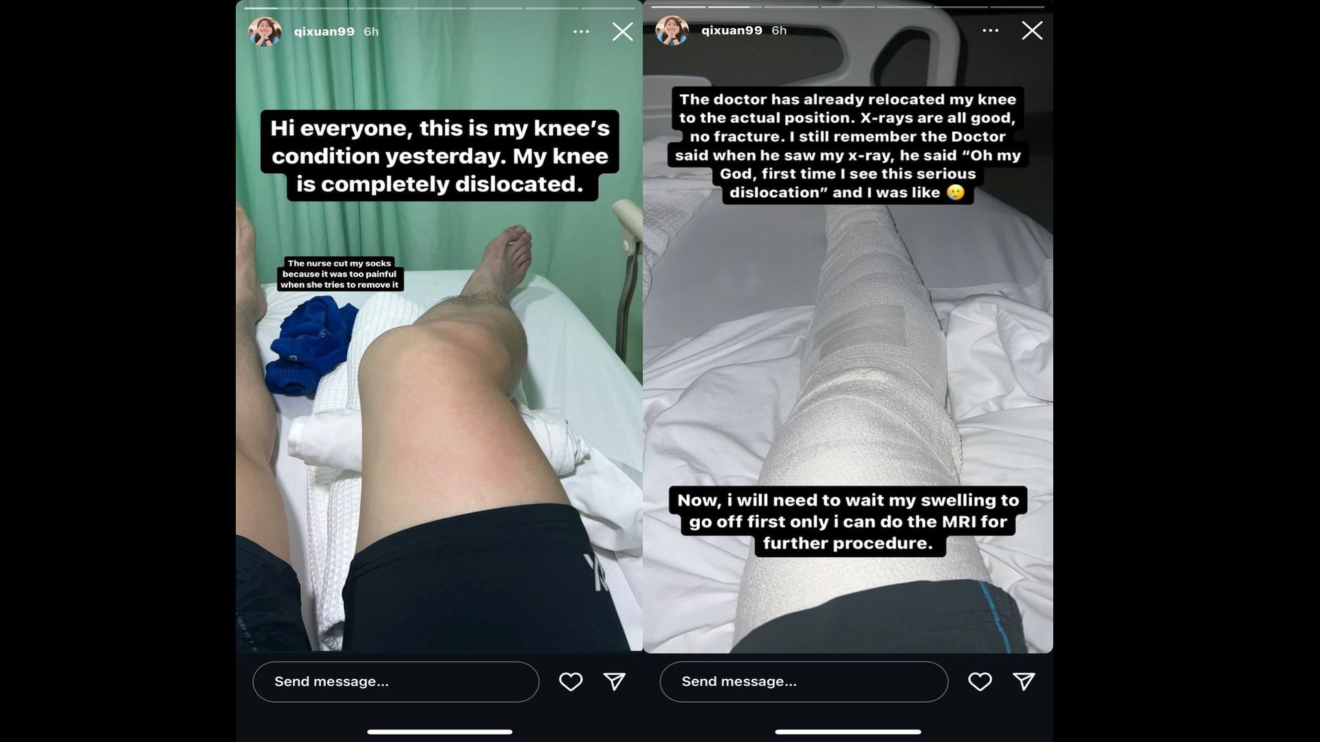 Pemain badminton negara kongsi gambar keadaan lutut yang terkehel ...