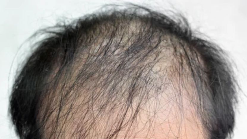 Thinning Hair: Causes and Remedies | Ulagam